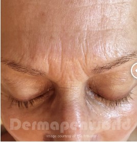 Les rides et ridules - Eklor